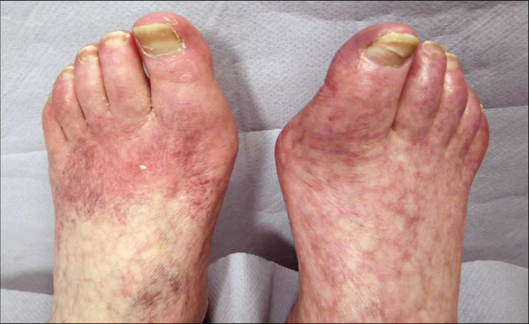 Diabetic Foot/Critical Limb Ischemia - Dr Sahaja Vascular Surgeon