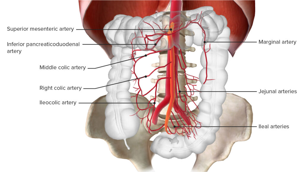 Acute Mesenteric Ischemia – Thrombolysis of SMA / Celiac Artery - Dr ...