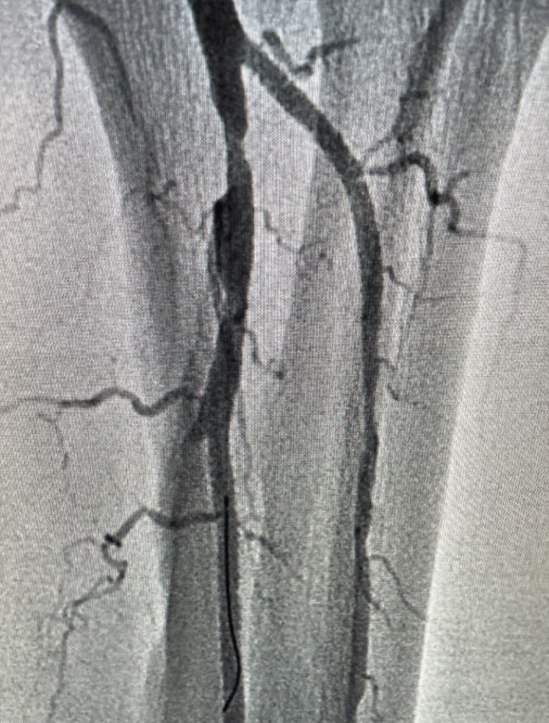 Iliac Vein Balloon Venoplasty / Stenting - Dr Sahaja Vascular Surgeon