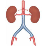 FemoroFemoral CrossOver Bypass - Dr Sahaja Vascular Surgeon