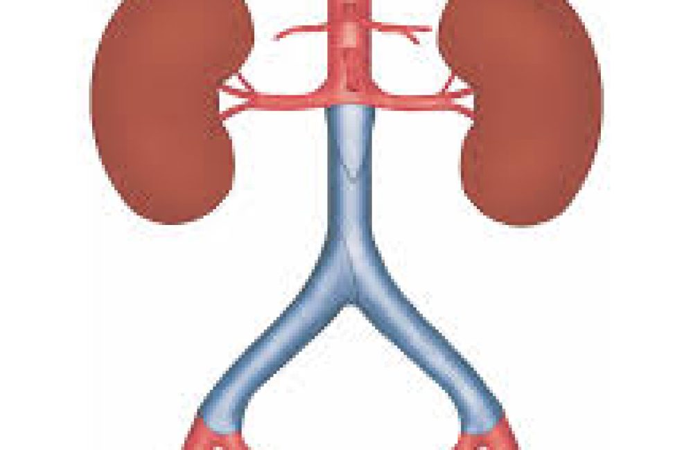 FemoroFemoral CrossOver Bypass - Dr Sahaja Vascular Surgeon